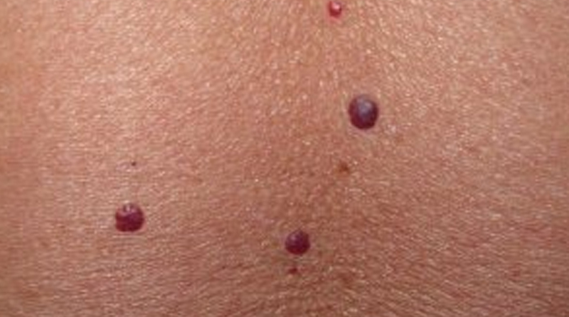 Puntos rojos en la piel - | La Urbe